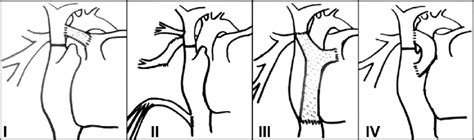 Schematic Drawings Showing All Techniques Used For The Creation Of A Download Scientific