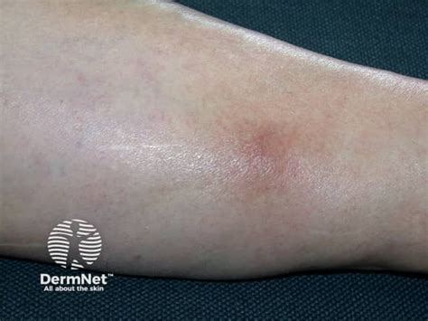 Ultrafhuaime Thrombophlebitis Superficial Penile Mondor Disease
