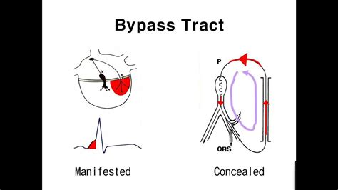 심전도 심전도의 기초5 Narrow Qrs Tachycardia Youtube