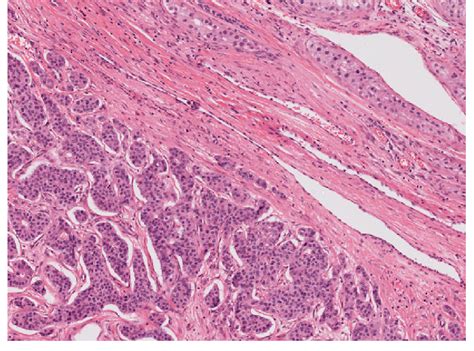 Pre Pubertal Type Testicular Neuroectodermal Tumour Download