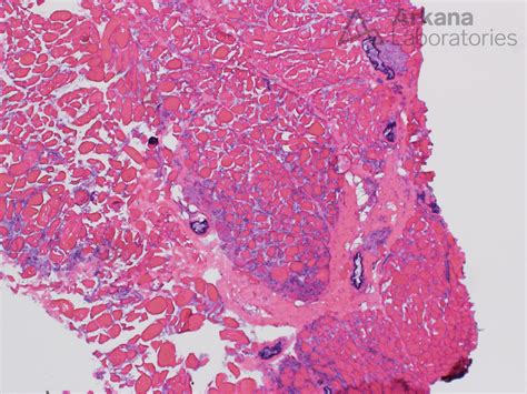 Calciphylaxis Neuro Notes Arkana Laboratories