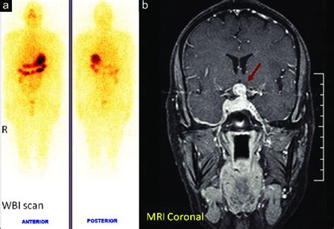 Follicular Carcinoma Of Thyroid And Cervical Lymph Nodal Metastases S P Download Scientific