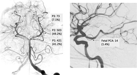Endovascular Versus Medical Management Of Posterior Cerebral Artery