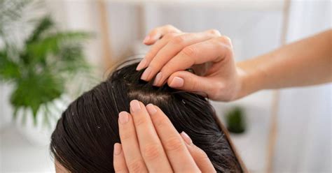 ¿tienes Mucha Caspa Presta Atención A Estos Consejos