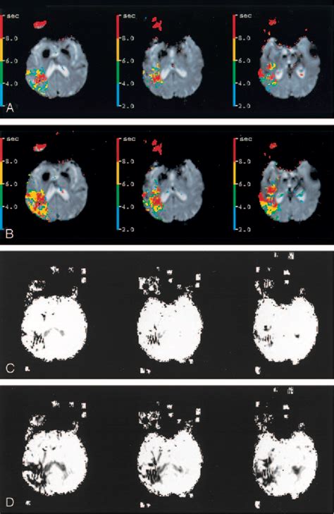 Figure 1 From Automated Method For Generating The Arterial Input Function On Perfusion Weighted