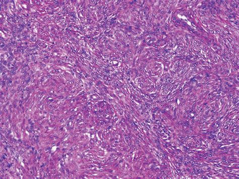 Histopathological Findings Of The Nodule In Nodule Appearance A In Download Scientific