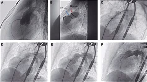 Implantation Of A Pulmonary Bioprosthetic Valve In A Single Pulmonary Implantation Of A Pulmonary Bioprosthetic Valve In A Single Pulmonary