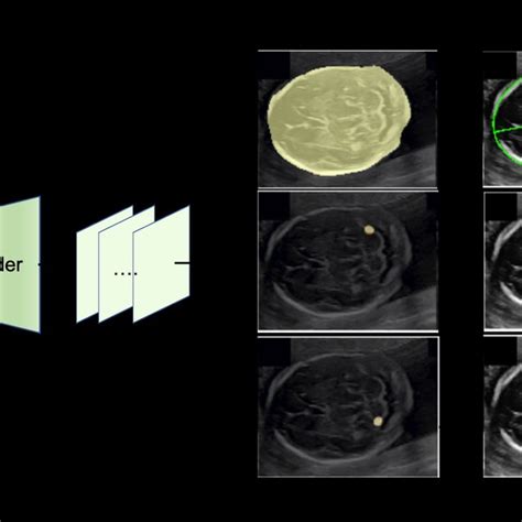 The Pipeline From Segmentation To The Final Biometry Download Scientific Diagram