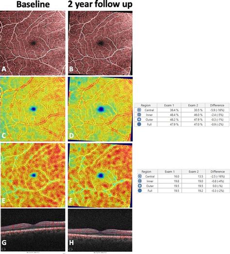 Mohammad Zubair Arain On Linkedin Longitudinal Analysis Of Retinal Microvascular And Choroidal
