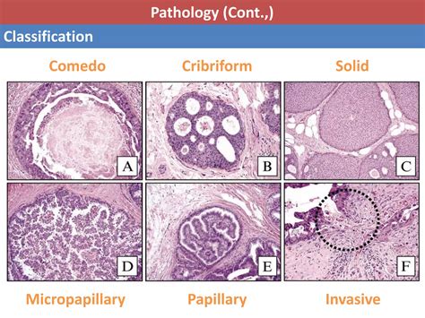 Ductal Carcinoma In Situ Dcis Pptx Cancer Diseases And Conditions