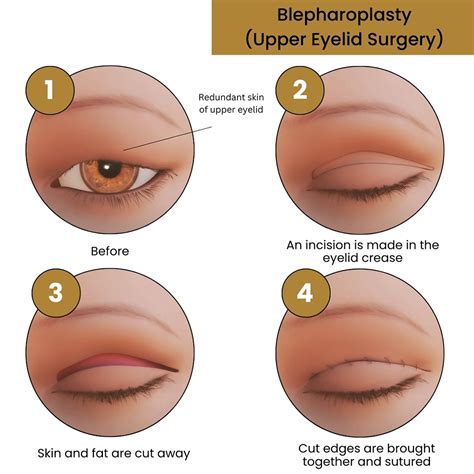 Blepharoplasty Procedure Types Of Blepharoplasty