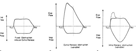 Muscular Dystrophy Flow Volume Loop