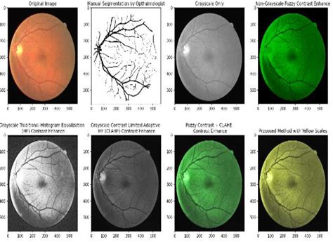 Figure 1 From A Novel Retinal Image Contrast Enhancement Fuzzy Based Method Semantic Scholar