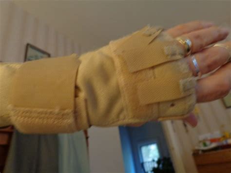 Ulnar Deviation Splint Doesnt Really Keep My Fingers Straight But It Has Helped To Rest My