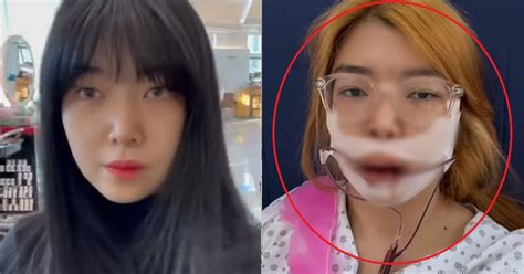 퇴사하고 양악광대턱끝 성형퉁퉁 부은 얼굴 공개한 나는 솔로 10기 영자