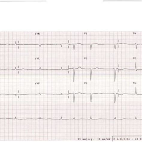 Diastolic Dysfunction In Early Stages Shown By E A Relation Download Scientific Diagram