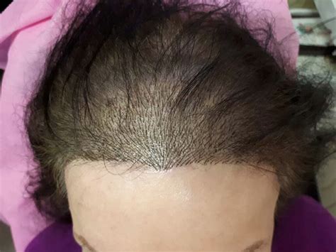 Scalp Microblading A Flawed Solution For Hair Loss