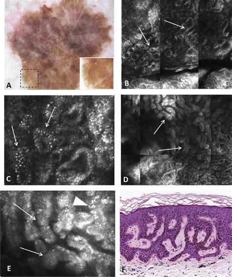 A Dermoscopy Showed A Light To Dark Brown Homogenous Reticular