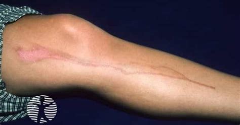 Phytophotodermatitis Image