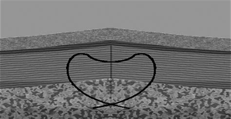 Modified Subcutaneous Buried Horizontal Mattress Suture Comp Annals Of Plastic Surgery