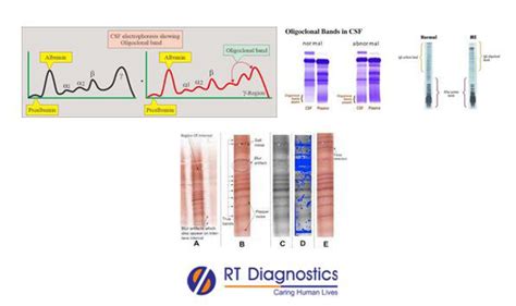 Electrophoresis Oligoclonal Band CSF RT Diagnostics