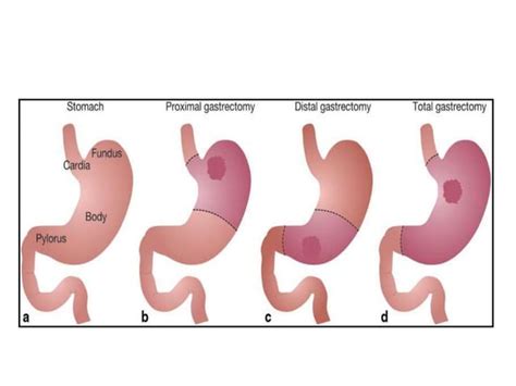Gastric Resection Reconstruction And Post Gastrectomy Syndromes