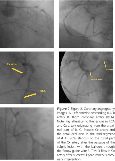 Acute Posterior Myocardial Infarction Semantic Scholar