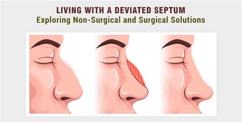 Living With A Deviated Septum Exploring Non Surgical And Surgical Solutions