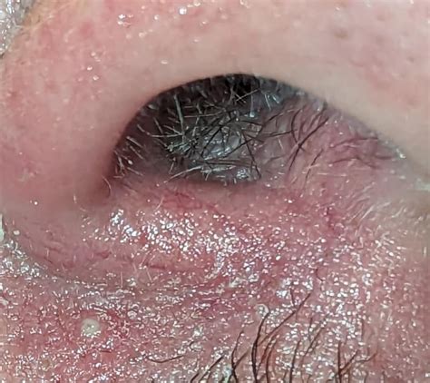 Nasal Folliculitis