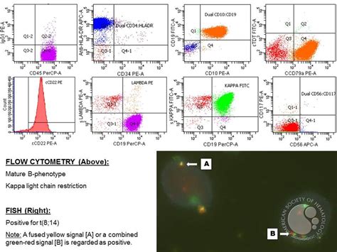 Burkitt Leukemia