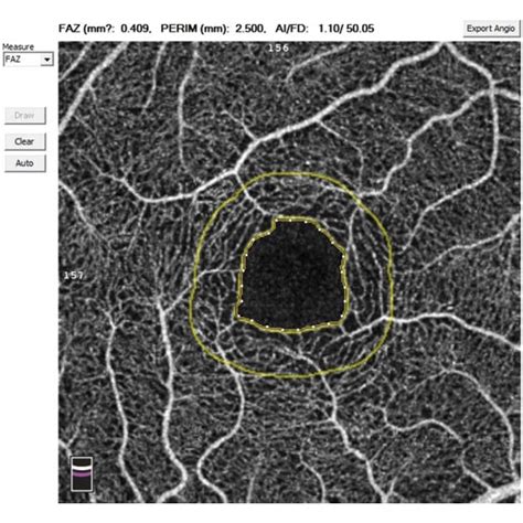 A The Superficial Retinal Capillary Plexus Between The Red And Green