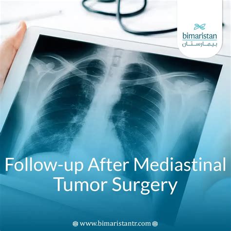 Follow Up After Mediastinal Tumor Surgery Full Guide