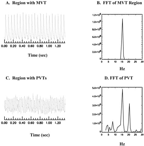 Mice Display Sex Differences In Halothane Induced Polymorphic Ventricular Tachycardia Circulation
