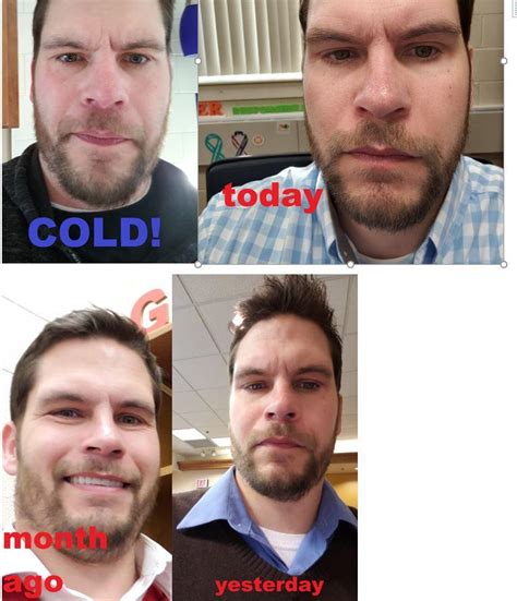 Is This Rosacea Or Reaction To Differin Rrosacea