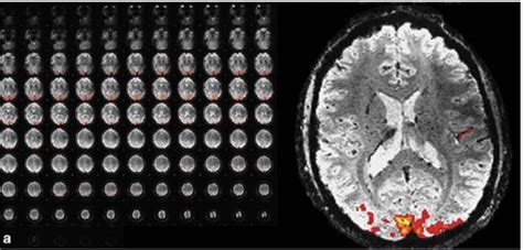 Eeg Imaging In Epilepsy Mapping Epileptic Activity Using Fmri