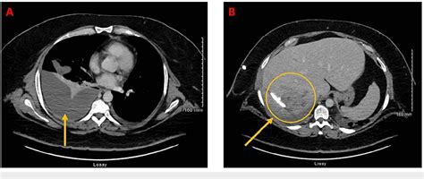 Figure 2 From Streptococcus Intermedius Bacteremia And Pyogenic Liver