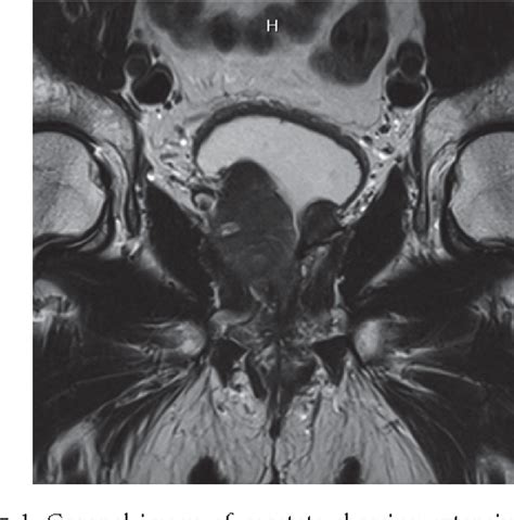 Figure 1 From Robotic Assisted Laparoscopic Prostatectomy Performed