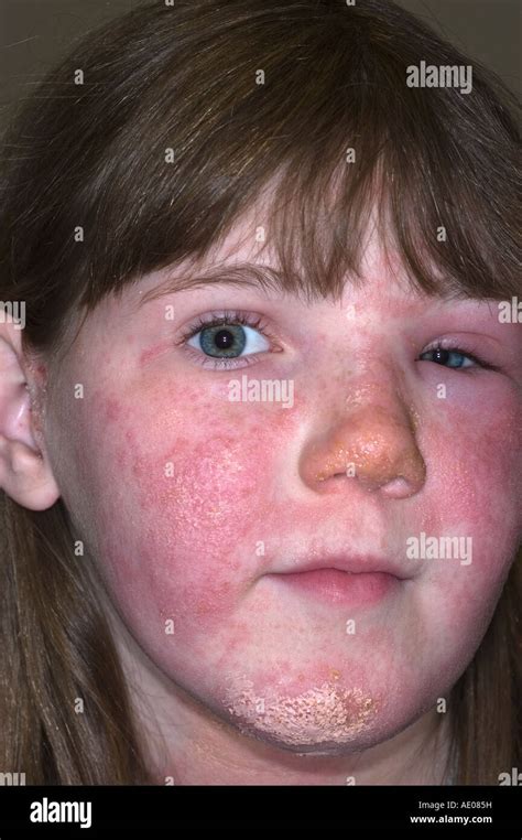 Poison Sumac Skin Reaction At Peggy Rios Blog