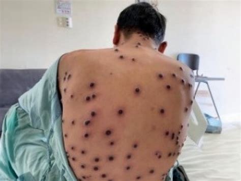 Confirma Ss Viruela Símica En Hermosillo Y Slrc