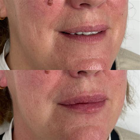 Can Botox Improve Nasolabial Folds What You Should Know
