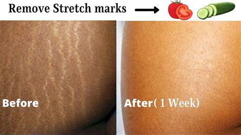 Does Tanning Help Fade Stretch Marks At Jill Ford Blog