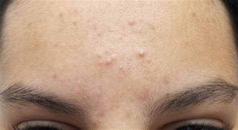 Can Any One Help Me Get Rid Of This Forehead Acne Racnetreatments