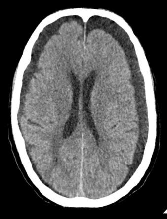Subdural Hematoma Ct