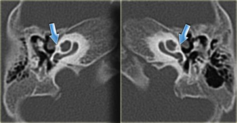 The Radiology Assistant Temporal Bone Pathology