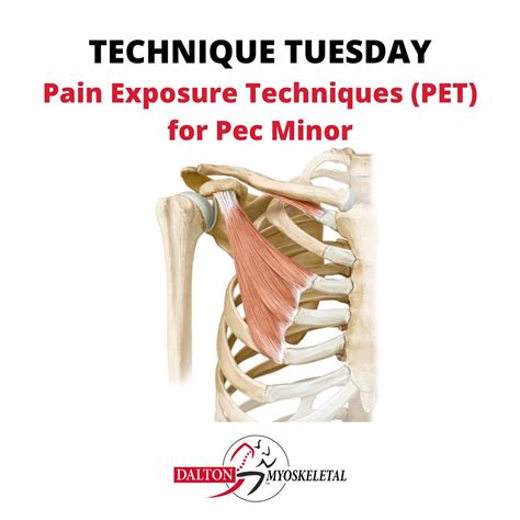Freedom From Pain Institute Llc On Linkedin Pectoralis Minor Is A