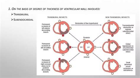 Myocardial Infarction Introduction Clinical Manifestation Classification Ecg Interpretation
