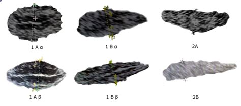 Artificial Intelligence Model Utilizing Endometrial Analysis To