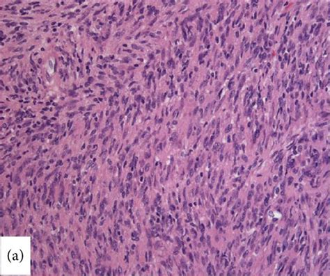Legend Hande Section 20x Shows A Spindle Cell Tumor Composed Of A Download Scientific