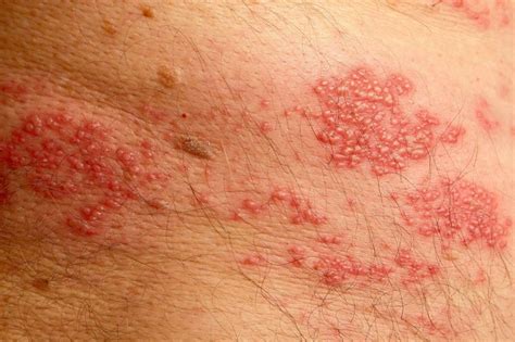 Show Pictures Of Shingles