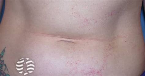 Psoriasis In Blaschko Distribution Image